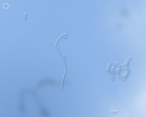 Eye floaters: what are they and what do they mean? - Tanner Eyes